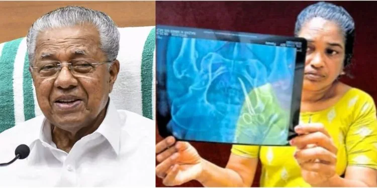 Kerala: Five years of pain after scissors left in woman’s abdomen